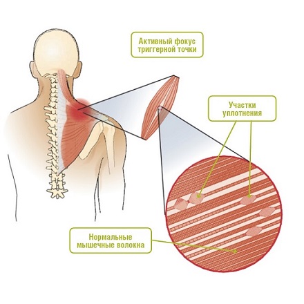 Массажный мяч Trigger Point MB Deep Tissue, 6.35 см — купить в интернет-магазине OZON с быстрой ...
